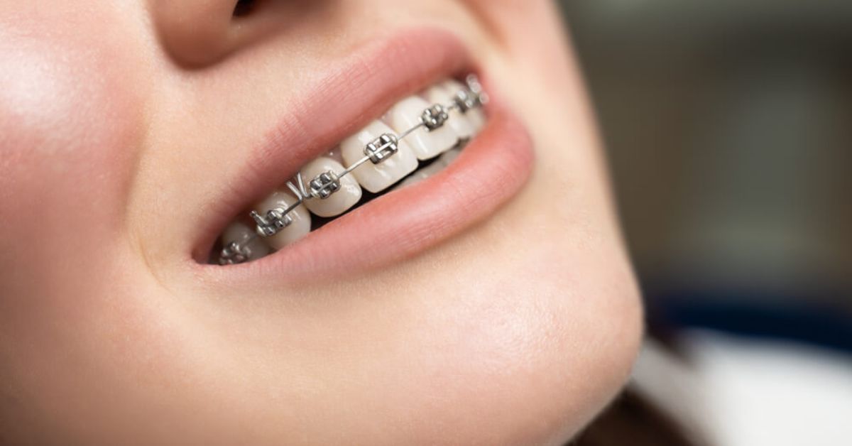 Behel Metal Konvensional Vs Behel Self Ligating Bedanya Apa