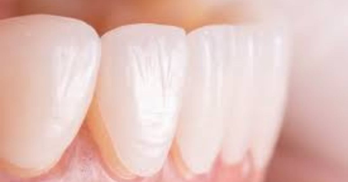 Veneer Gigi Surabaya - Our Treatment